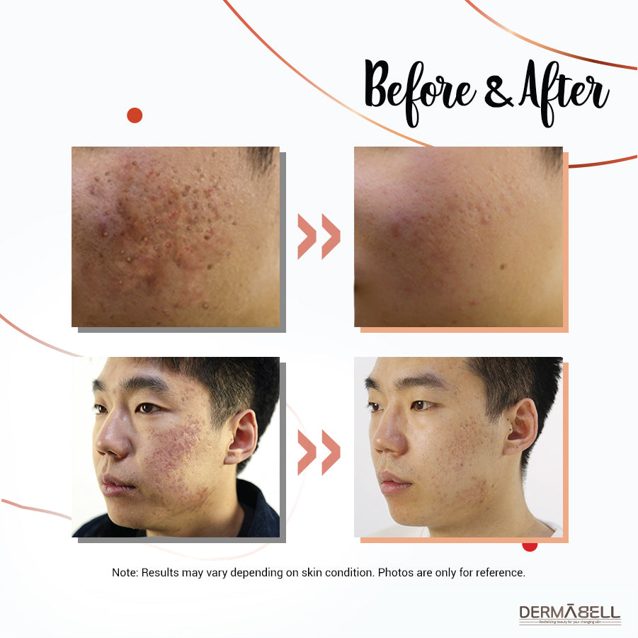 AC Line | Acne-Preventative Skincare | DERMABELL PRO